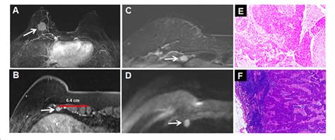 Mri Of The Breast Tumor And Intercostal Lymph Node A Mip Images