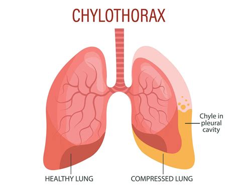 Chylothorax Lung Diseases Healthcare Medical Infographic Banner