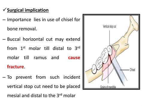 Third Molar Impaction Basic Pptx