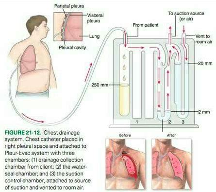 Bubbling Chest Tube Assessment 106 Chest Tube Drainage Systems