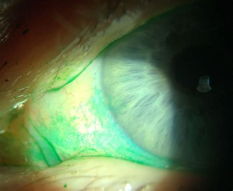 How To Improve Contact Lenstear Interactions