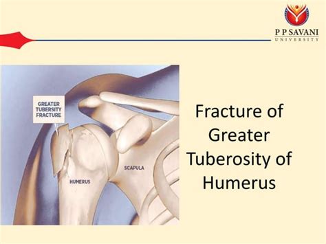 3 Fracture Of Greater Tuberosity And Surgical Neck Of Humerus Pptx