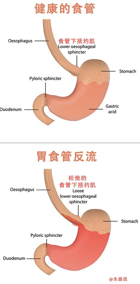 关于胃酸与烧心99 9 的人理解错了 知乎