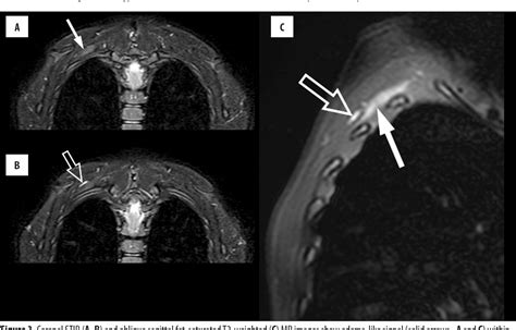 Scapulothoracic Bursitis Mri Radiology At Antonio Fore Blog