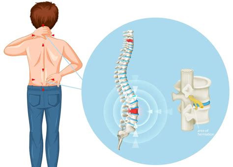 What Is A Herniated Disc Symptoms And Treatment Methods