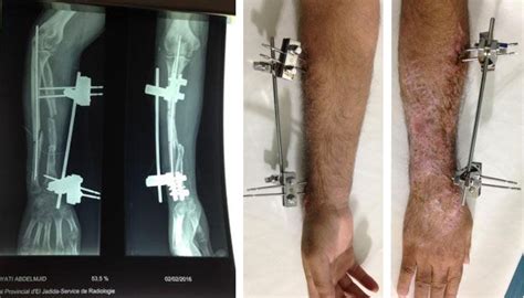Pseudarthrose De Lavant Bras Kader Yettefti Ali Chirurgien