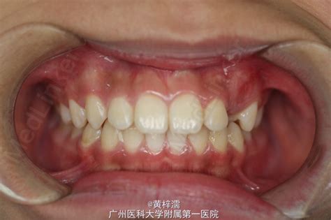阻生尖牙牵引一例 医联
