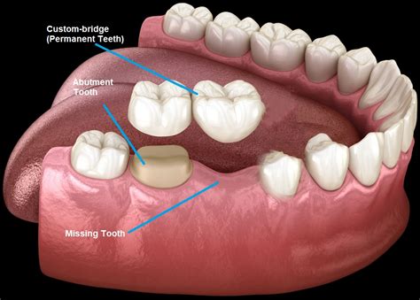 Dental Bridge Procedure And Different Types A Complete Guide