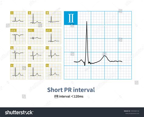 Prolonged Pr Interval