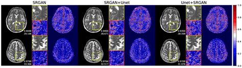 Recovery Of ×8 Low Resolution K Space Undersampling With The Radial