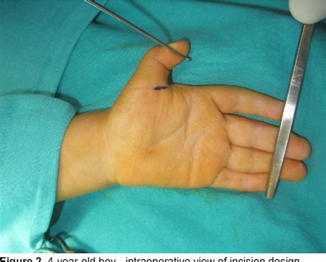 Figure 4 From Trigger Thumb And Finger In Pediatric Patients Semantic Scholar