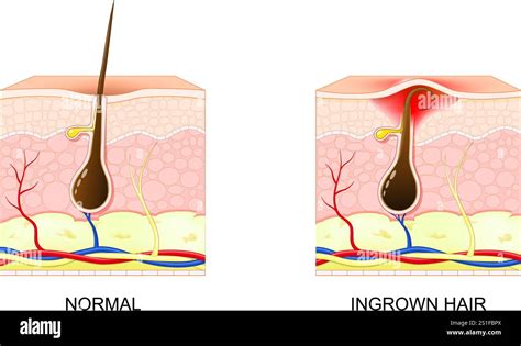 Ingrown Hair Hair Follicle Entrapment Shaving Irritation Comparison