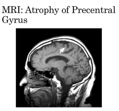 ALS Flashcards Quizlet
