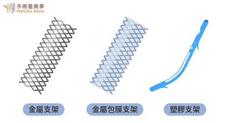 膽道阻塞裝支架救命 塑膠、金屬材質該怎麼選？