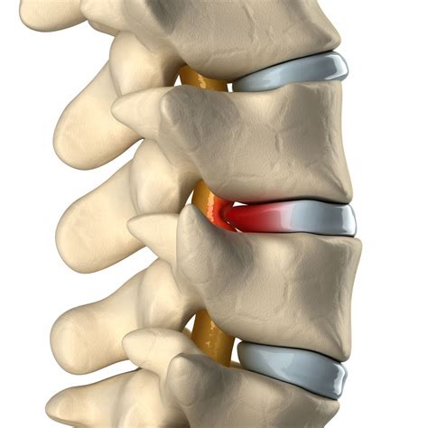 Central Canal Stenosis Symptoms And Causes