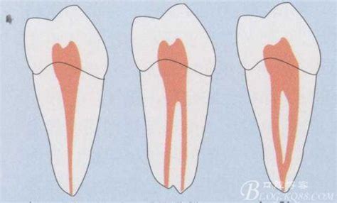 下颌第一前磨牙的根管治疗张昌龙 张昌龙的博客 KQ88口腔博客
