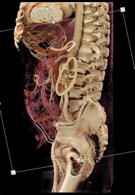 Gastric Gist Tumor Stomach Radiology Case Studies Ctisus Ct Scanning
