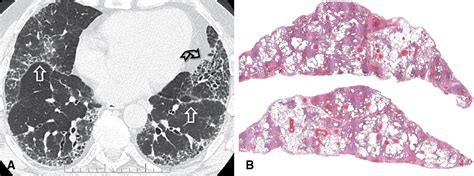 Computed Tomography Of Diffuse Lung Diseases And Solitary Pulmonary