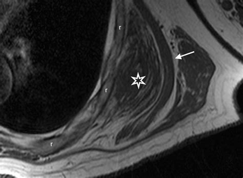 Elastofibroma Dorsi Radsource