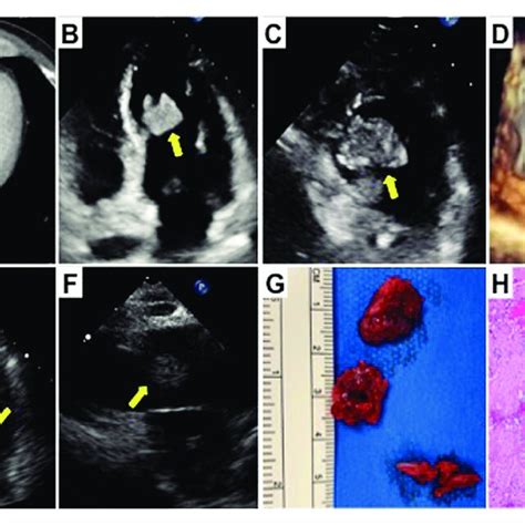 A Chest Computed Tomography Ct Scan Filling Defect In The Left Download Scientific Diagram