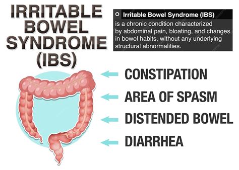 Premium Vector Irritable Bowel Syndrome Ibs Infographic