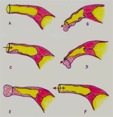 Cervico Vaginal Prolapse Prolapse Of Cervix And Vagina