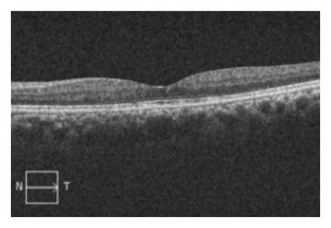 Preoperative Fundus Picture In Patient 11 Shows Diffuse Retinal Download Scientific Diagram