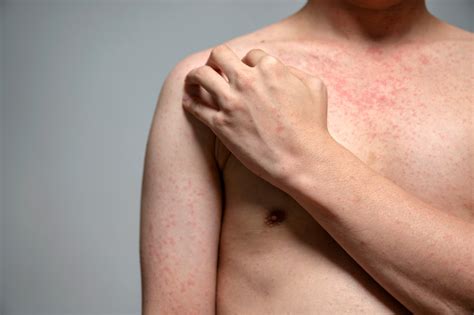 Amid Rising Measles Cases A New Generation Of Doctors Is Being Taught