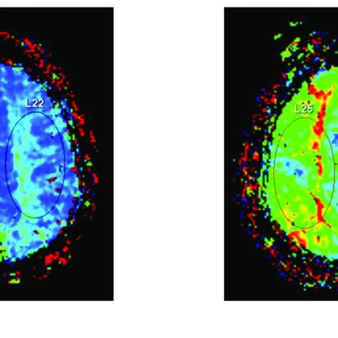 Perfusion Weighted Magnetic Resonance Imaging Regions Of Interest Were Download Scientific