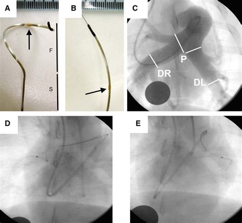 Pulmonary Artery Denervation Pdn Catheter And Procedure Prototype