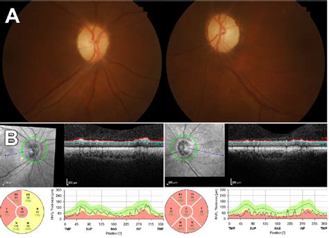 A Fundus Photo Showing Bilateral Eye Optic Atrophy B Oct