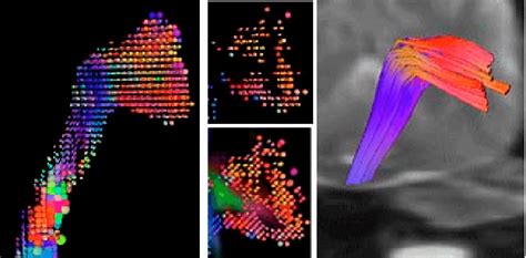 Atlas Based Dtt Result The Left Cbt Left Tensors Of P Lcbt X0
