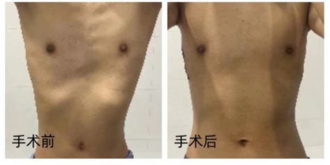 医院新闻漏斗胸的微创手术治疗NUSS手术