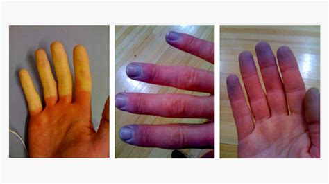 Raynaud S Phenomenon Guide Causes Symptoms And Treatm