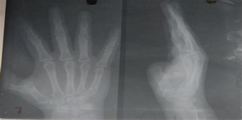 Left Thumb Anteroposterior A And Lateral B Radiographs At