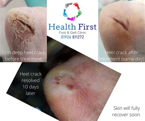 The Cost Of Cracked Heels Health First Foot And Gait Clinic