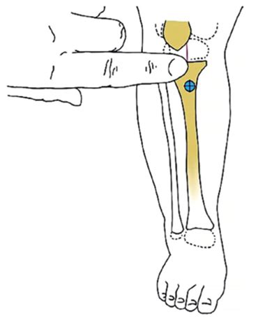 Tibia Proximal Io Arrow EZ IO T A L O N Needle Set