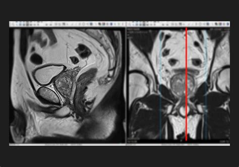 Enhanced Prostate Cancer Segmentation With Multimodal Mri