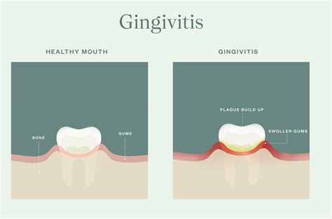 Gingivitis Treatment Guidelines At Stanley Urbina Blog