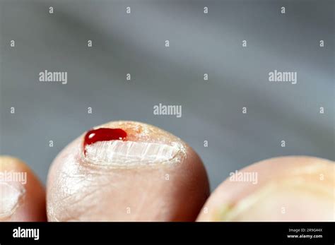 Bleeding On The Tip Of The Second Toe Of The Left Foot Insult Of The
