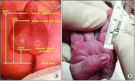 Measurement Of Anogenital Distance Agd And 24 Digit Lengths A Agd