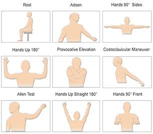 Thoracic Outlet Syndrome Thoracic Outlet Syndrome Exercises Thoracic