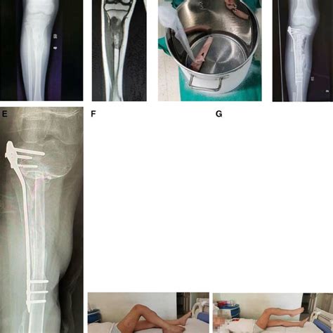 A The Preoperative X Ray B The Preoperative Mri C Autologous Download Scientific