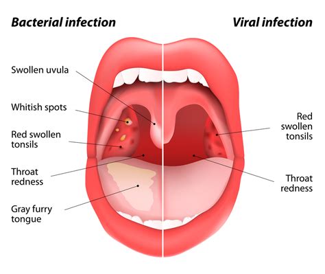 Severe Tonsillitis