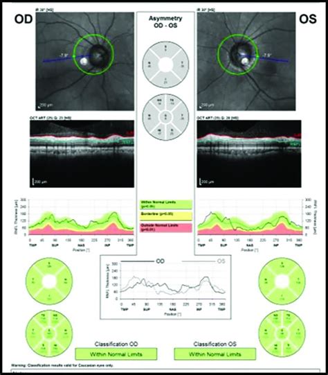 Seven Common Errors In Glaucoma Management And How To Avoid Them Insight