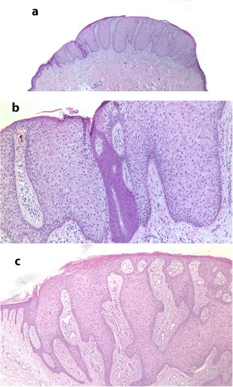 [translated Article] Clear Cell Acanthoma A Series Of 70 Cases Actas Dermo Sifiliográficas