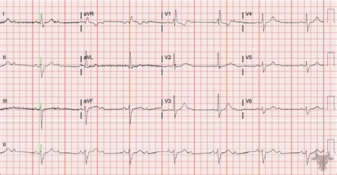 Left Anterior Fascicular Block Ecg Stampede
