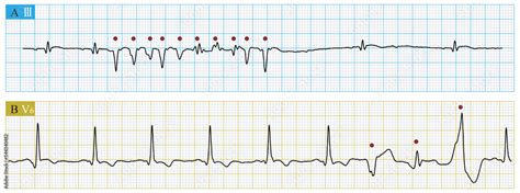 Polymorphic Ventricular Tachycardia Is A Malignant Ventricular Tachyarrhythmia The Qrs Wave