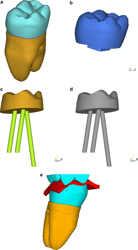 Three Dimensional Finite Element Analysis Of Molars With Thin Walled Prosthetic Crowns Made Of
