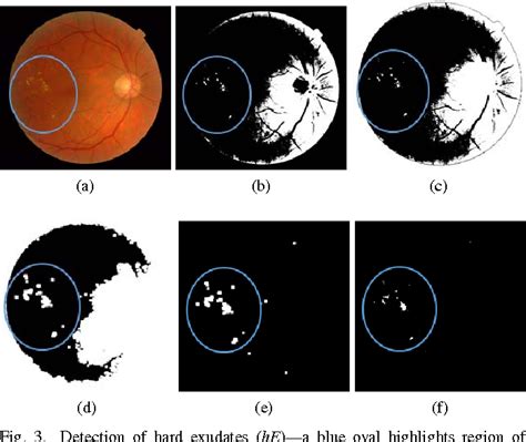 Figure 1 From Automated Detection Of Diabetic Retinopathy Using Svm